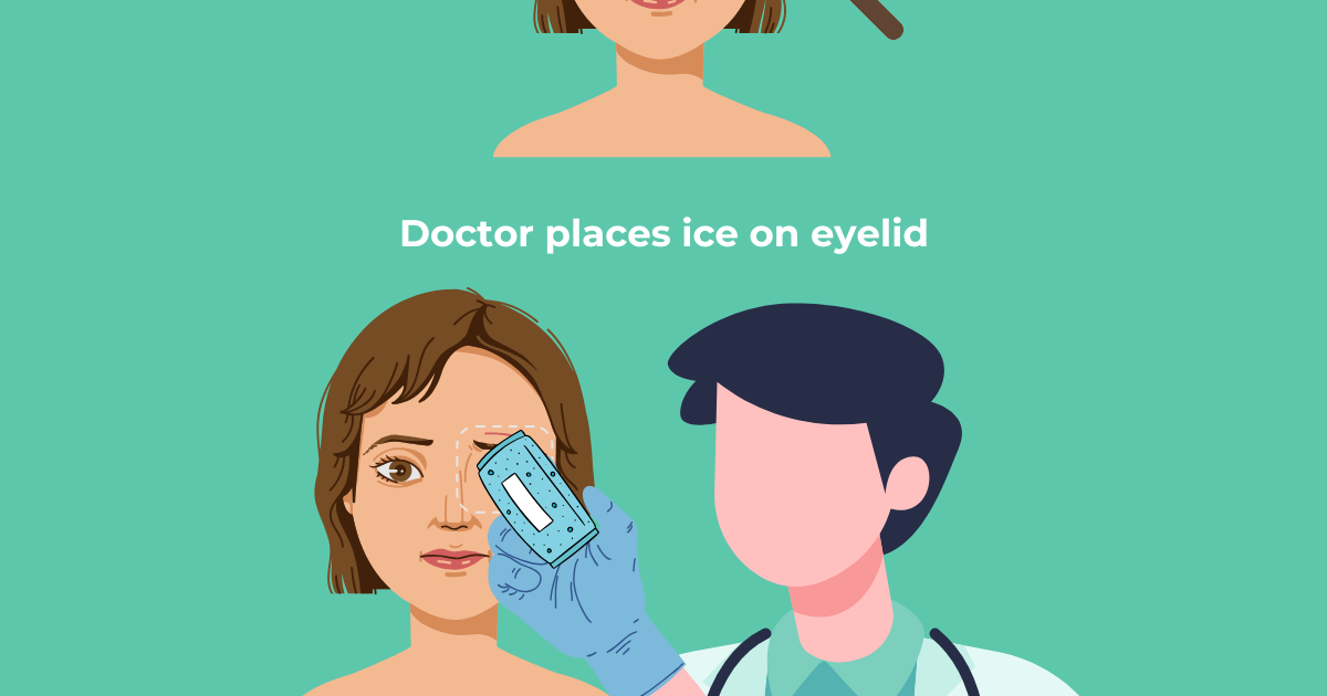 Myasthenia gravis ice pack test: A step-by-step guide | Myasthenia ...